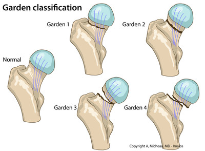 Fracture du col du fémur / Classifications / Radiologie / Chaines / e ...