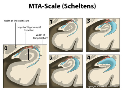 MTA-scale for Medial Temporal lobe Atrophy (Scheltens) / Radiological ...