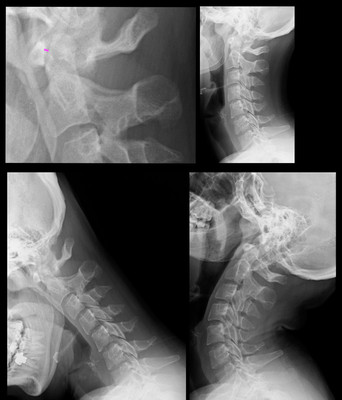 Atlantoaxial Subluxation/Dislocation / Radiological classifications ...