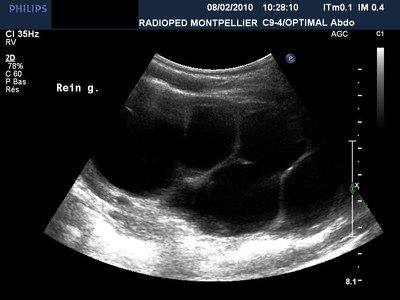 Syndrome de la jonction pyélo-urétérale / Radiopédiatrie / Chaines ...