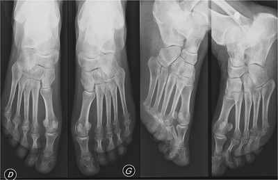 Polyarthrite rhumatoïde / Ostéo-articulaire / Chaines publiques / e ...